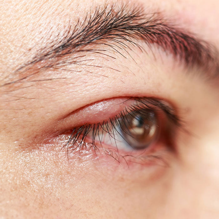 Stye Treatment with Eye-Press: Patented Self-Heating Compress for Dry ...